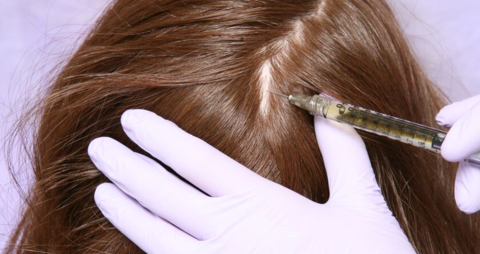 How Many PRP Sessions Should I Take For Hair Loss?