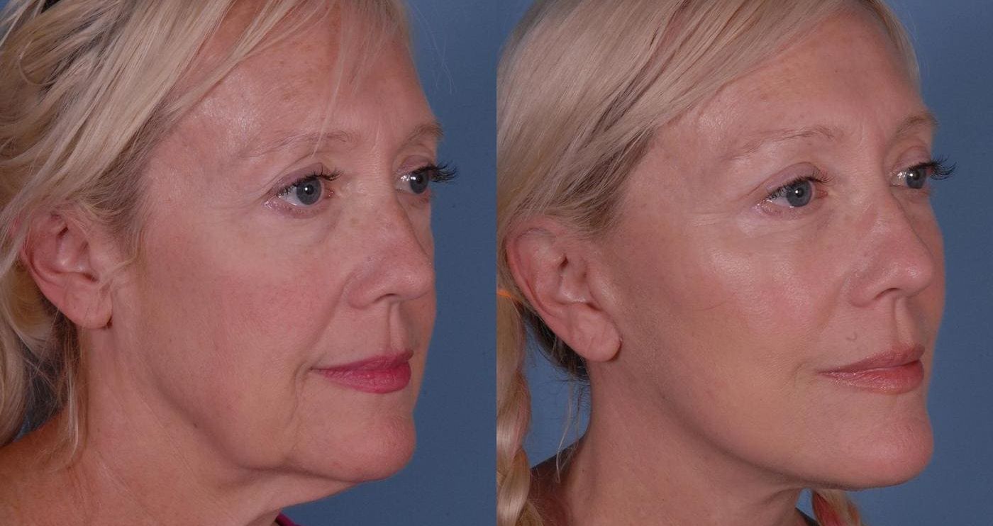 5 Benefits of a Mini Facelift