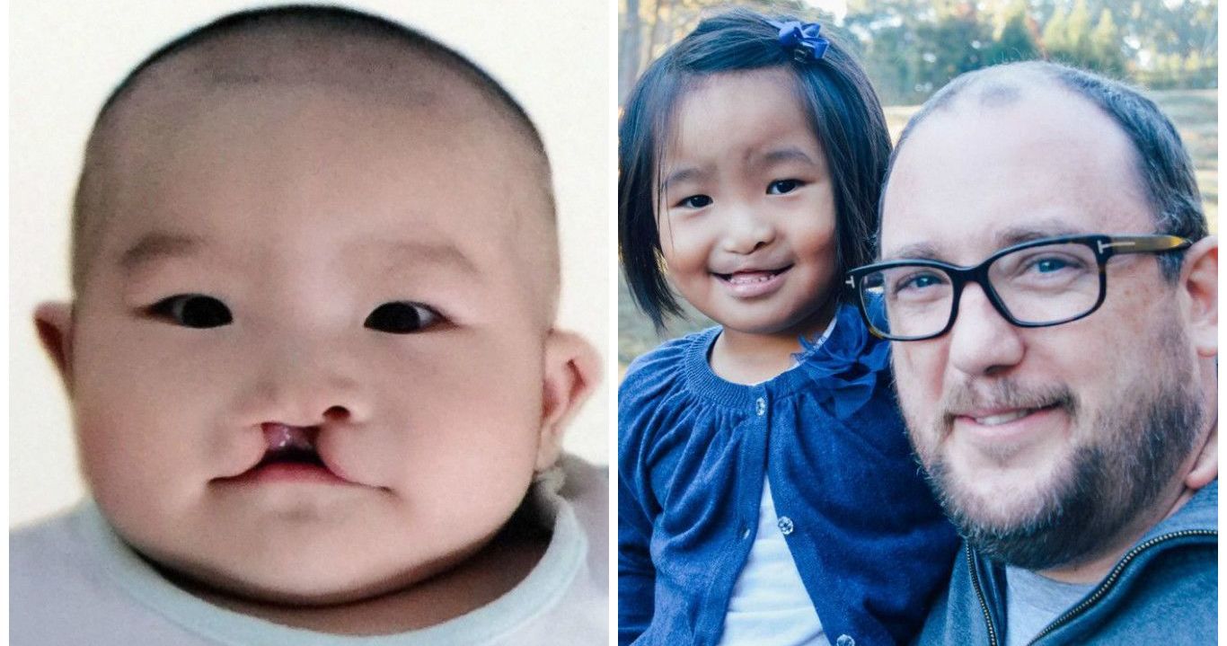 This Dad Who Was Born With A Cleft Palate Adopted A Child With The Same ...