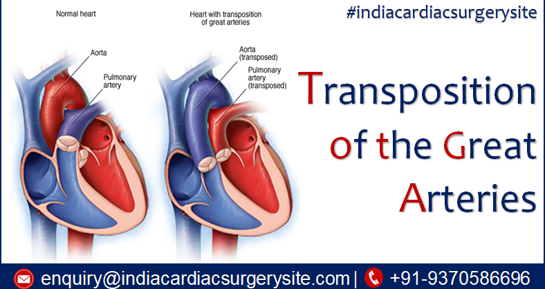 Transposition of the Great Arteries Surgery In India: Things to ...