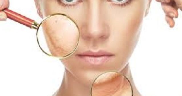 ACNE Treatment Gives You Relief from Blemishes and Spots